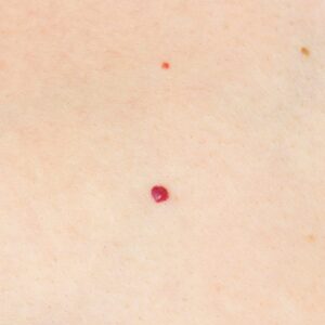 Effective Angioma Treatment Options: What You Need to Know
