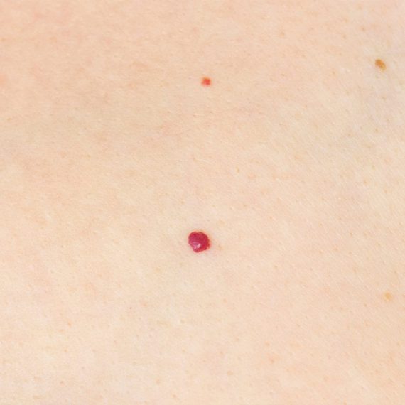 Effective Angioma Treatment Options: What You Need to Know