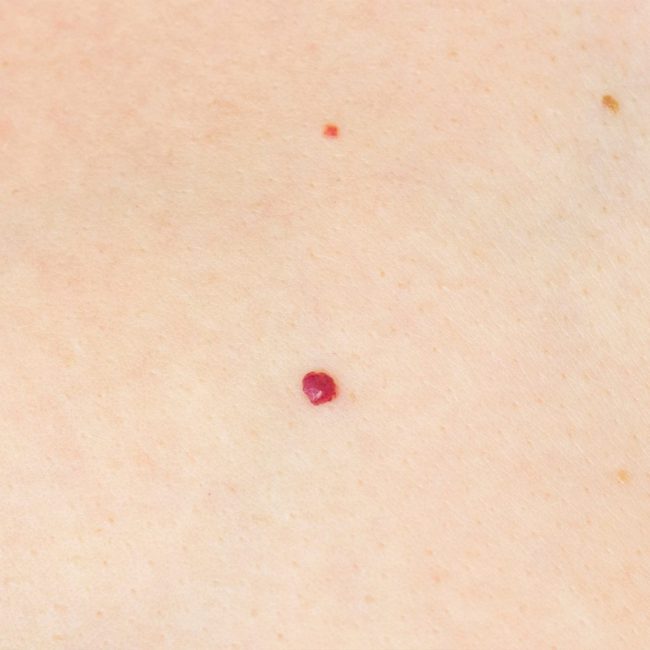 Effective Angioma Treatment Options: What You Need to Know