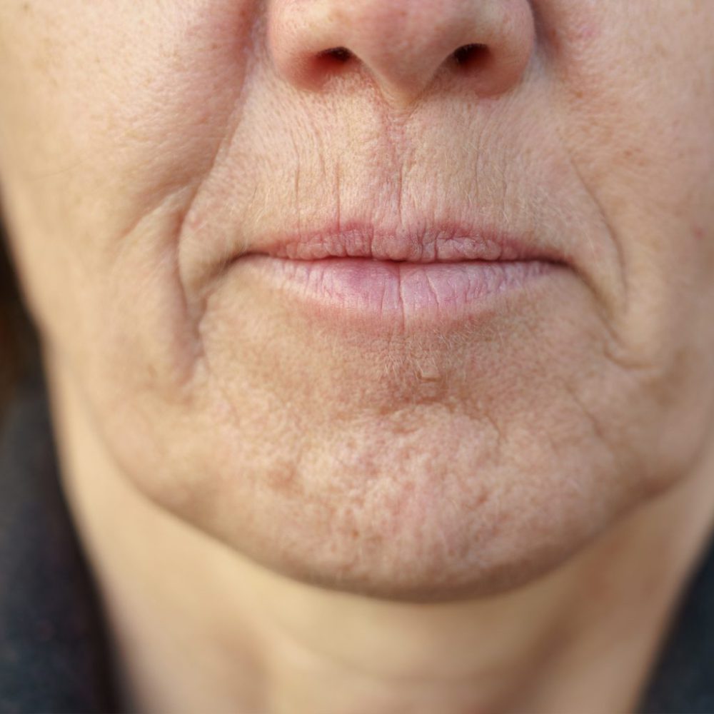 Chin Dimple Botox: Enhance Your Smile With Precision | MMC