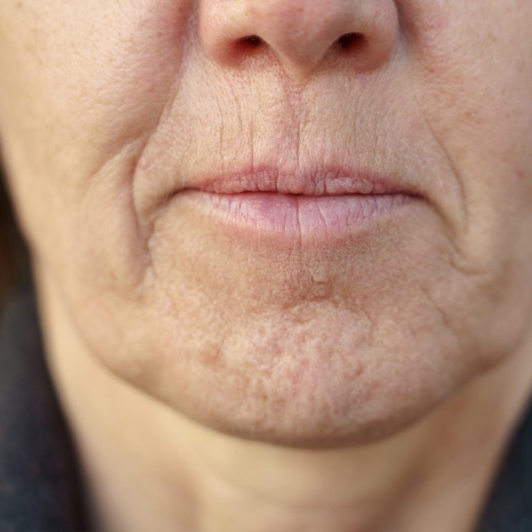 Chin Dimple Botox: Enhance Your Smile With Precision | MMC