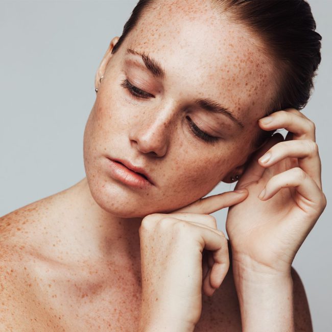 Best Freckles Treatment For Clear Complexion | MMC Aesthetic