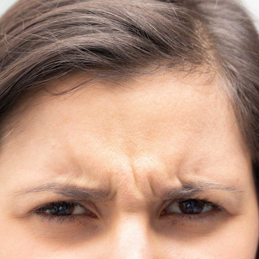 Effortless Beauty: Glabellar Lines Treatment Choices | MMC